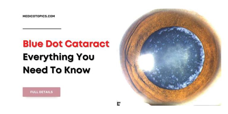 Blue Dot Cataract - Everything You Need To Know